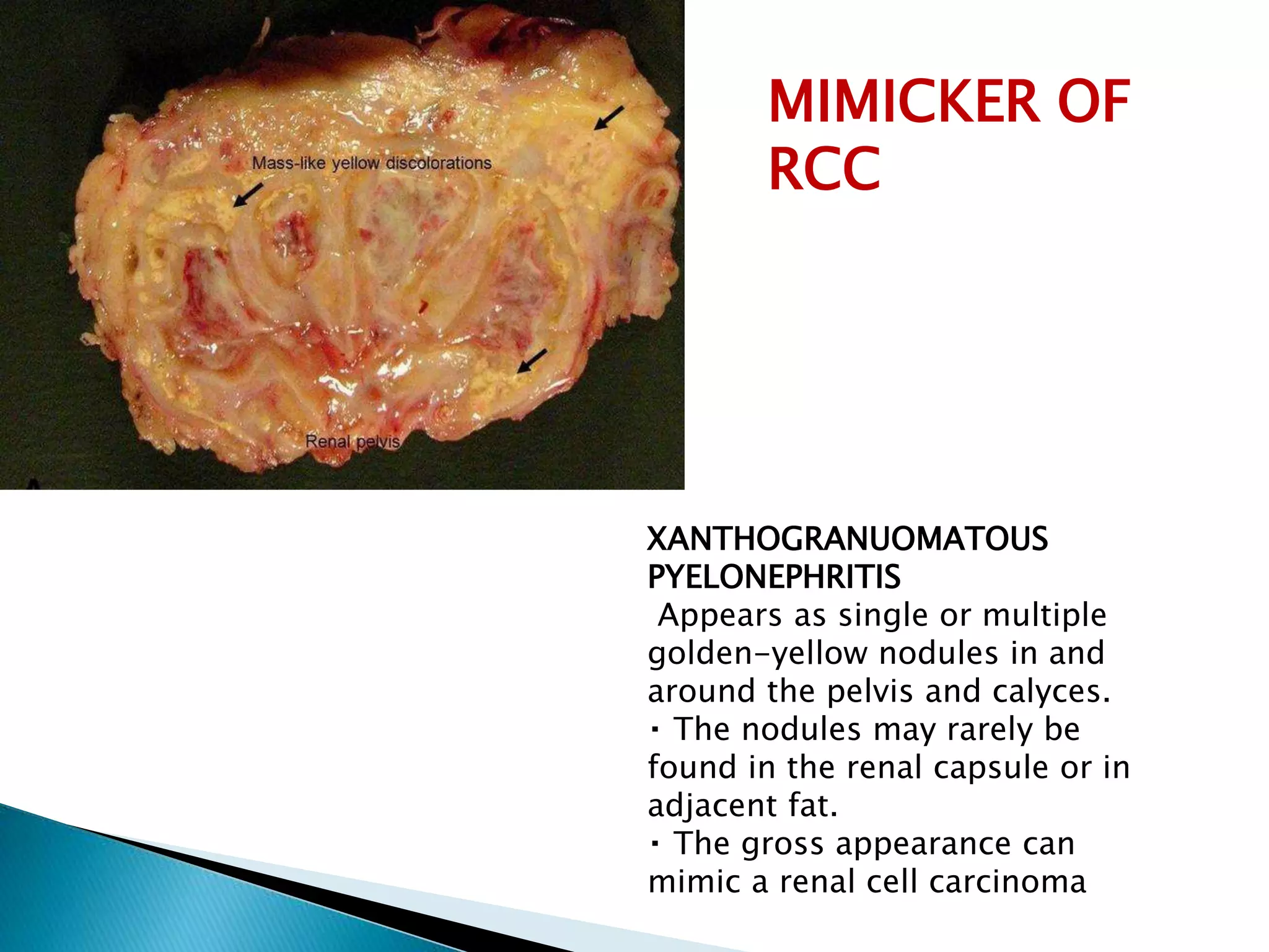 Grossing of kidney tumors | PPTX