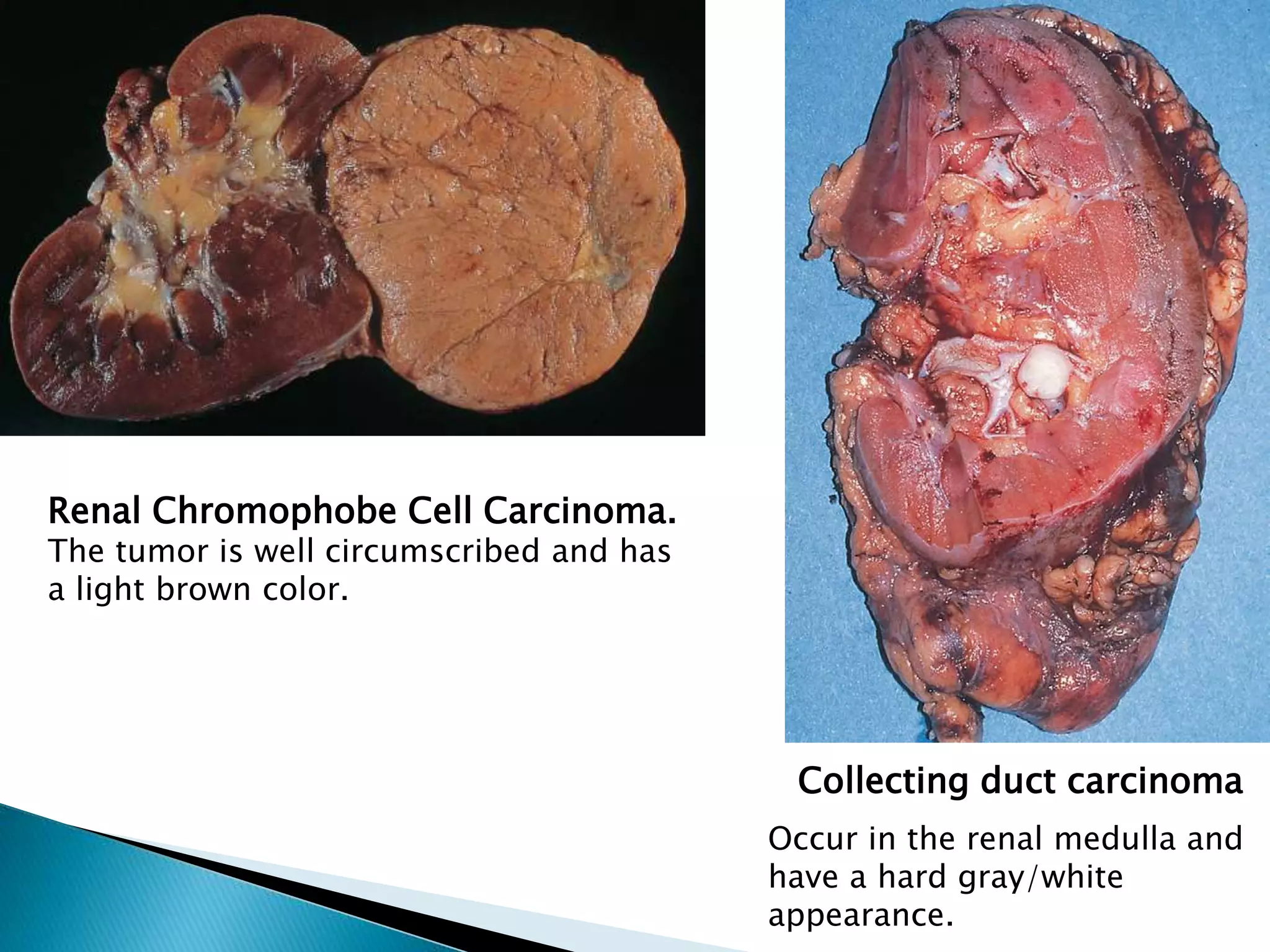 Grossing of kidney tumors | PPTX