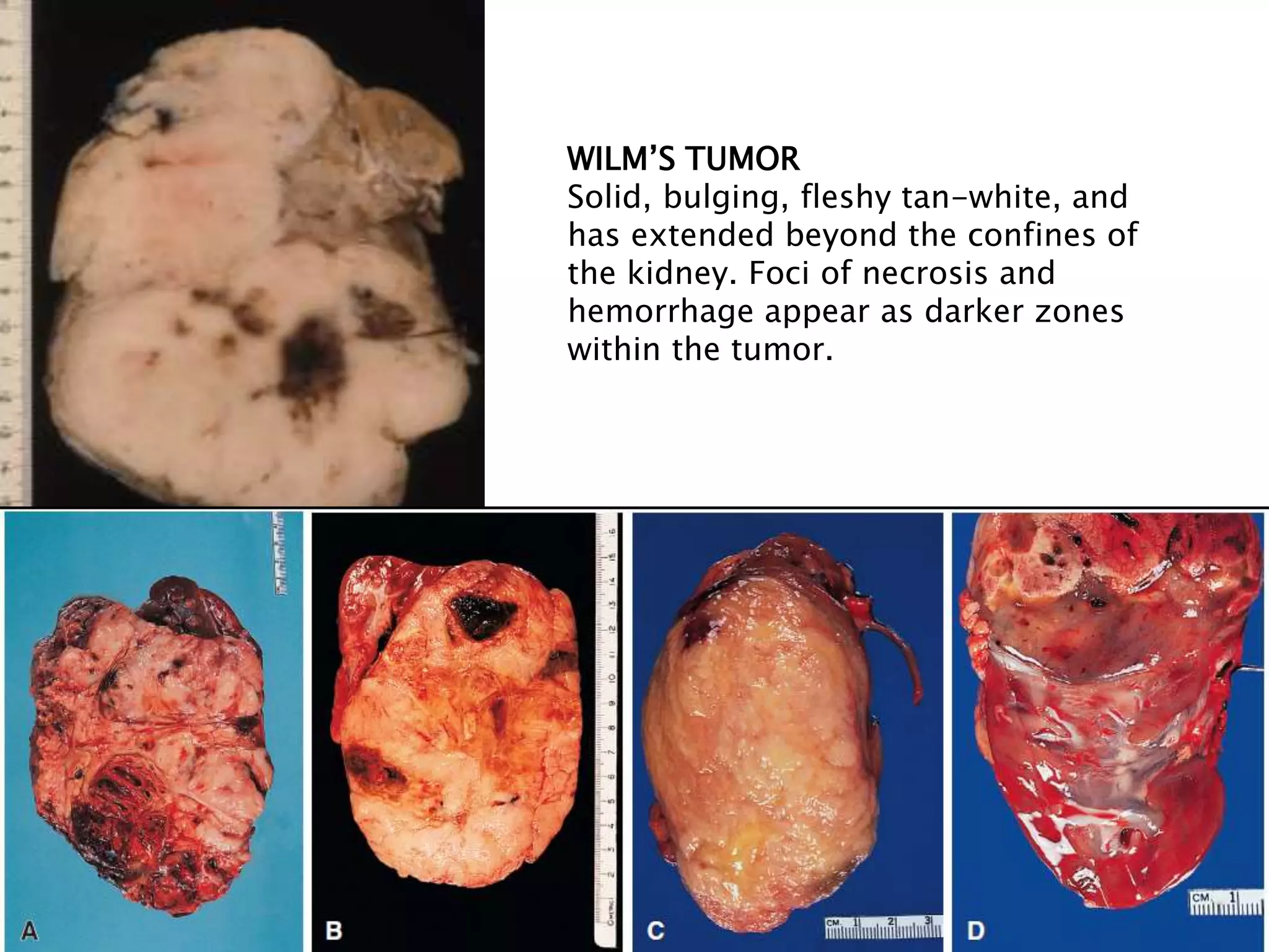 Grossing of kidney tumors | PPTX