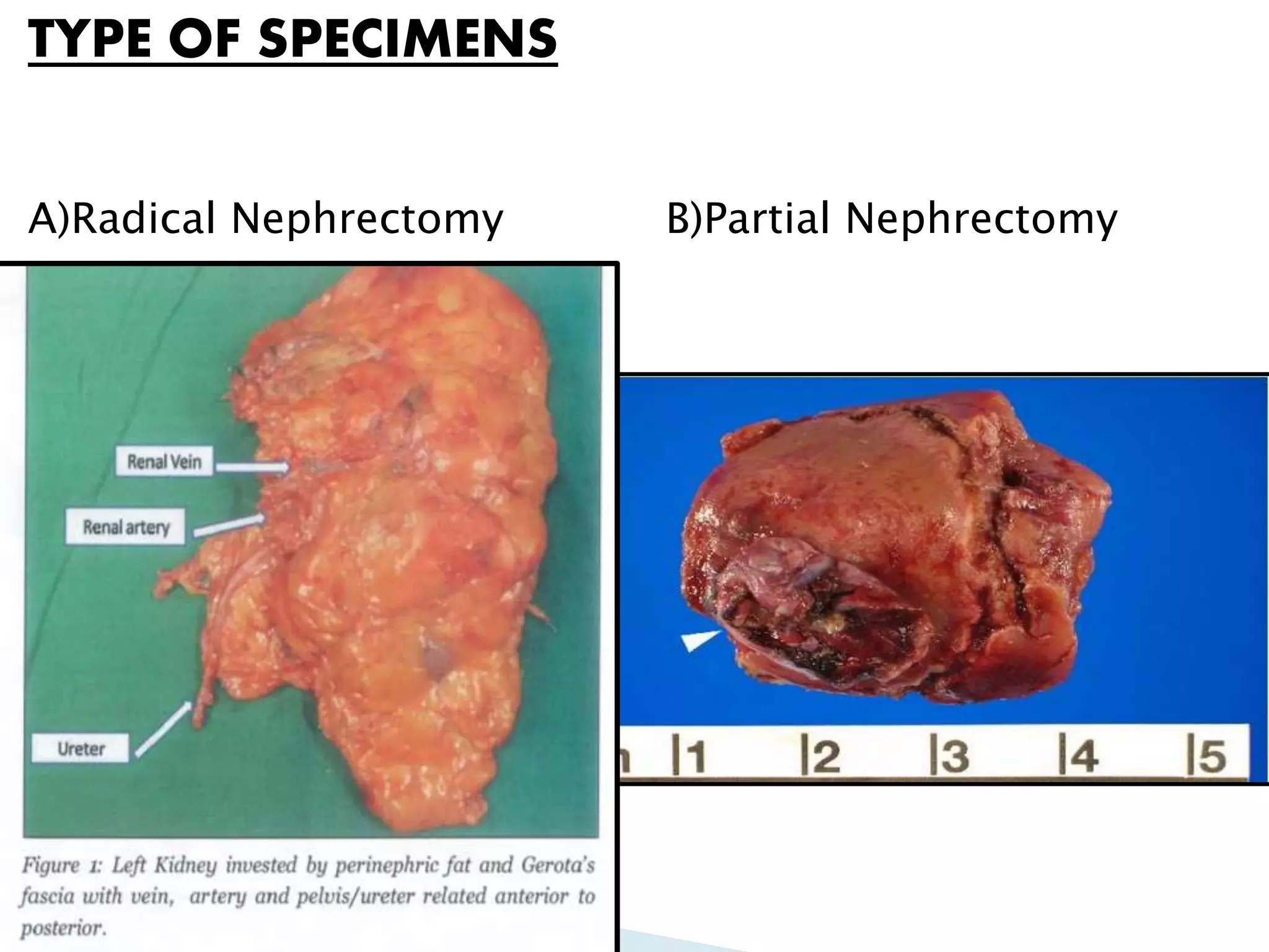 Grossing of kidney tumors | PPTX