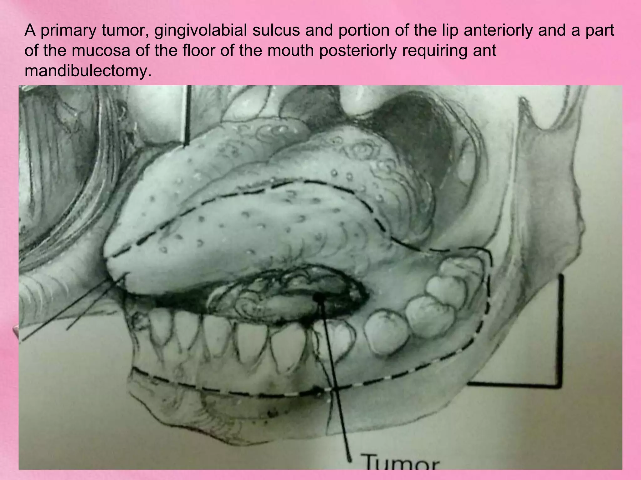 Grossing of mandibulectomy specimen - Dr Pranav, MGIMS | PPTX