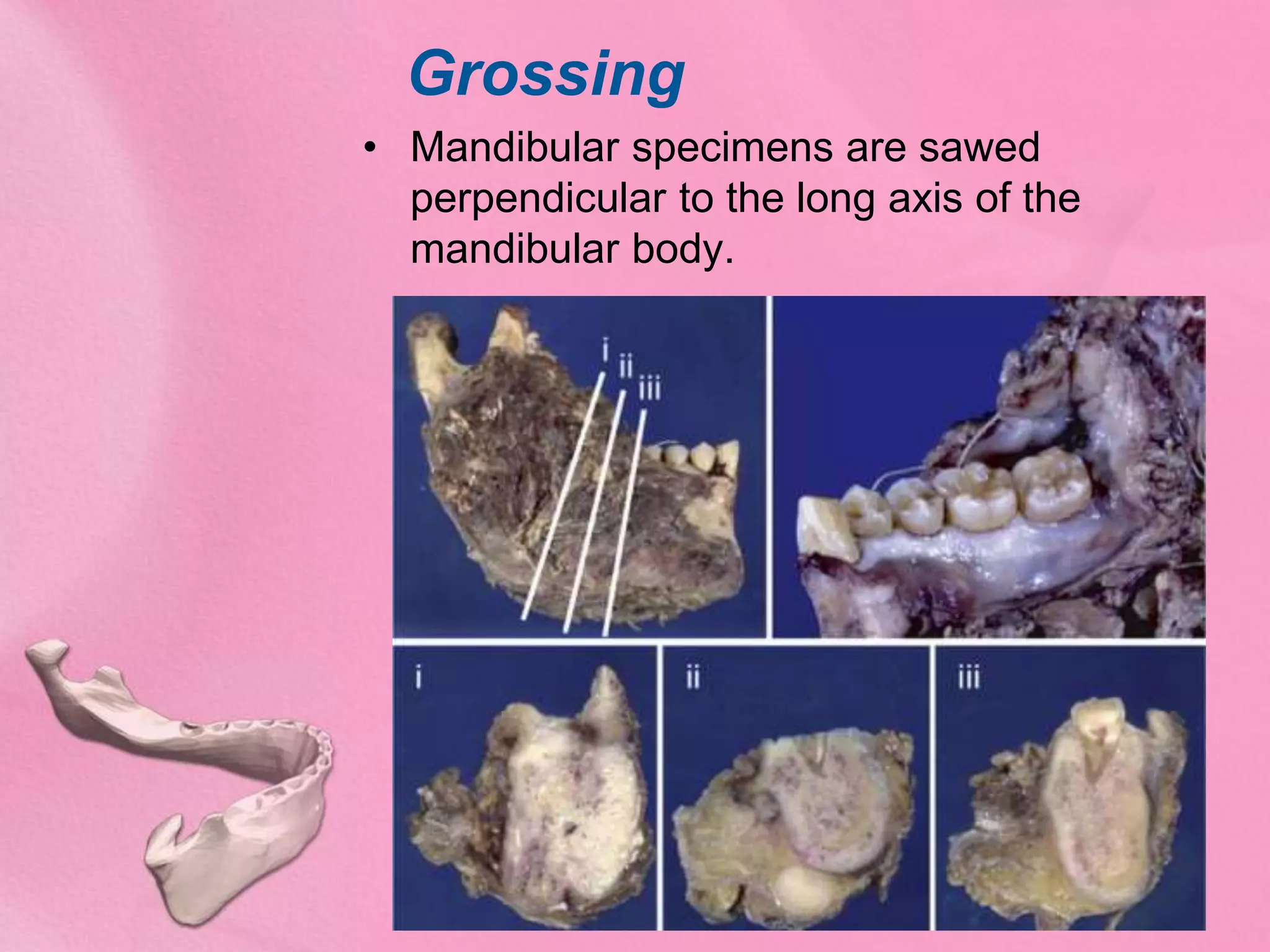 Grossing of mandibulectomy specimen - Dr Pranav, MGIMS | PPTX