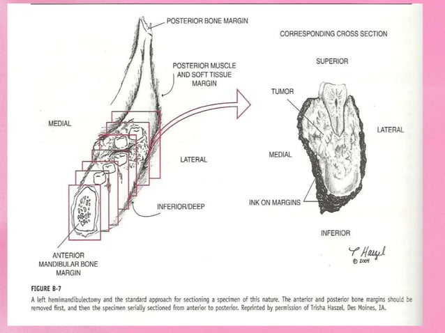 Grossing of mandibulectomy specimen - Dr Pranav, MGIMS | PPTX