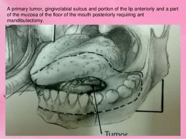 Grossing of mandibulectomy specimen - Dr Pranav, MGIMS
