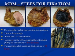 Grossing of breast specimens.pptmain | PPT