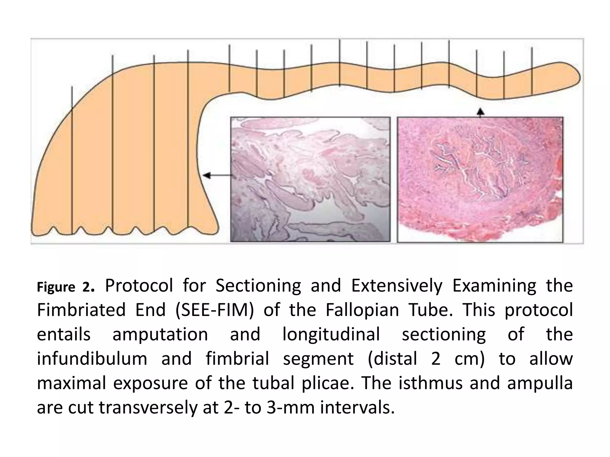 grossing of ovarian tumors.pptx