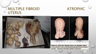 Histopath Grossing of uterus cervix &ovary | PPTX