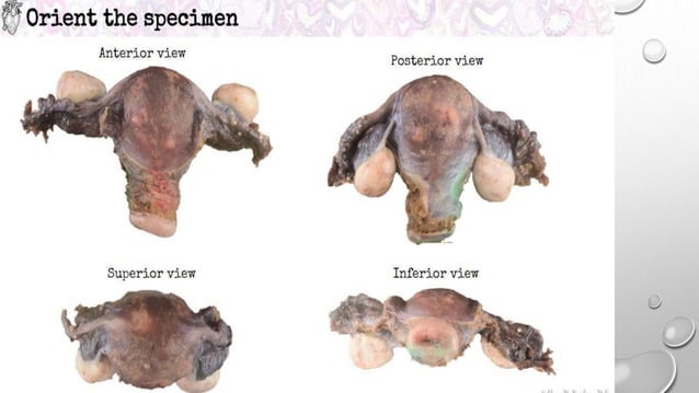 Histopath Grossing of uterus cervix &ovary | PPTX