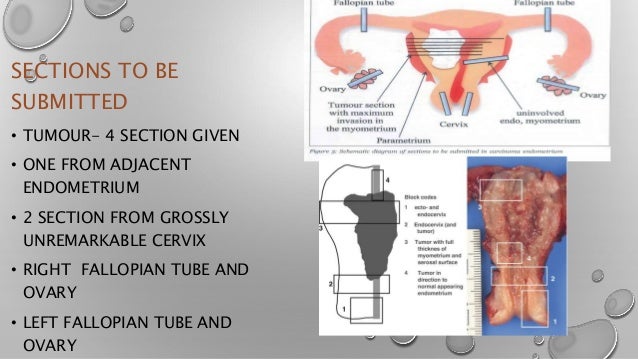 Histopath Grossing of uterus cervix &ovary