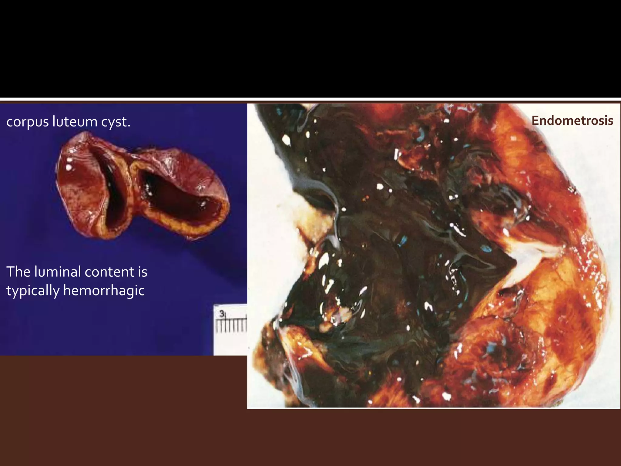 Grossing procedure for ovary | PPTX