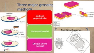 GROSSING PTNM journal club for MDS GRADUATES.... | PPTX
