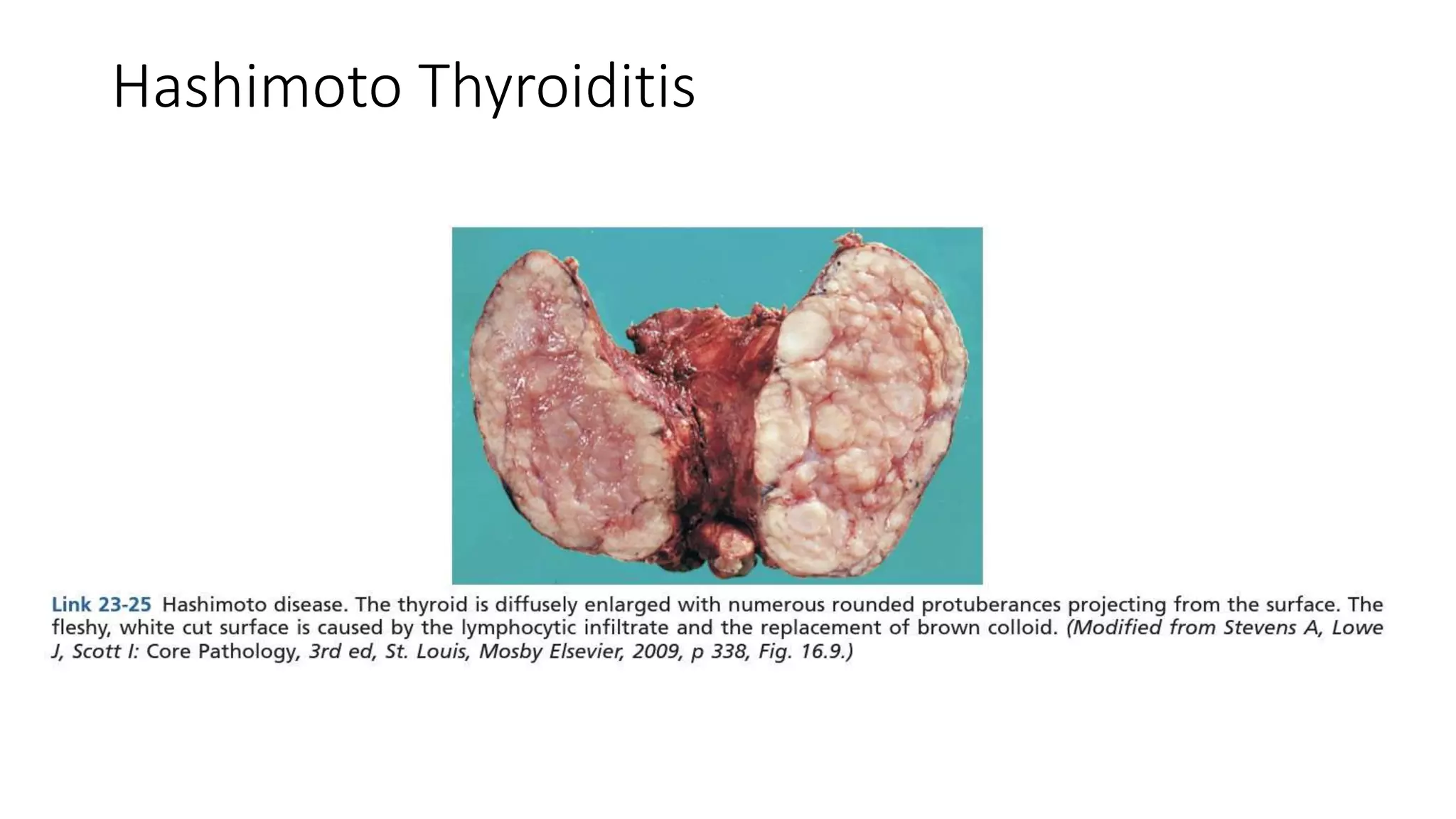 Grossing thyroid gland | PPTX