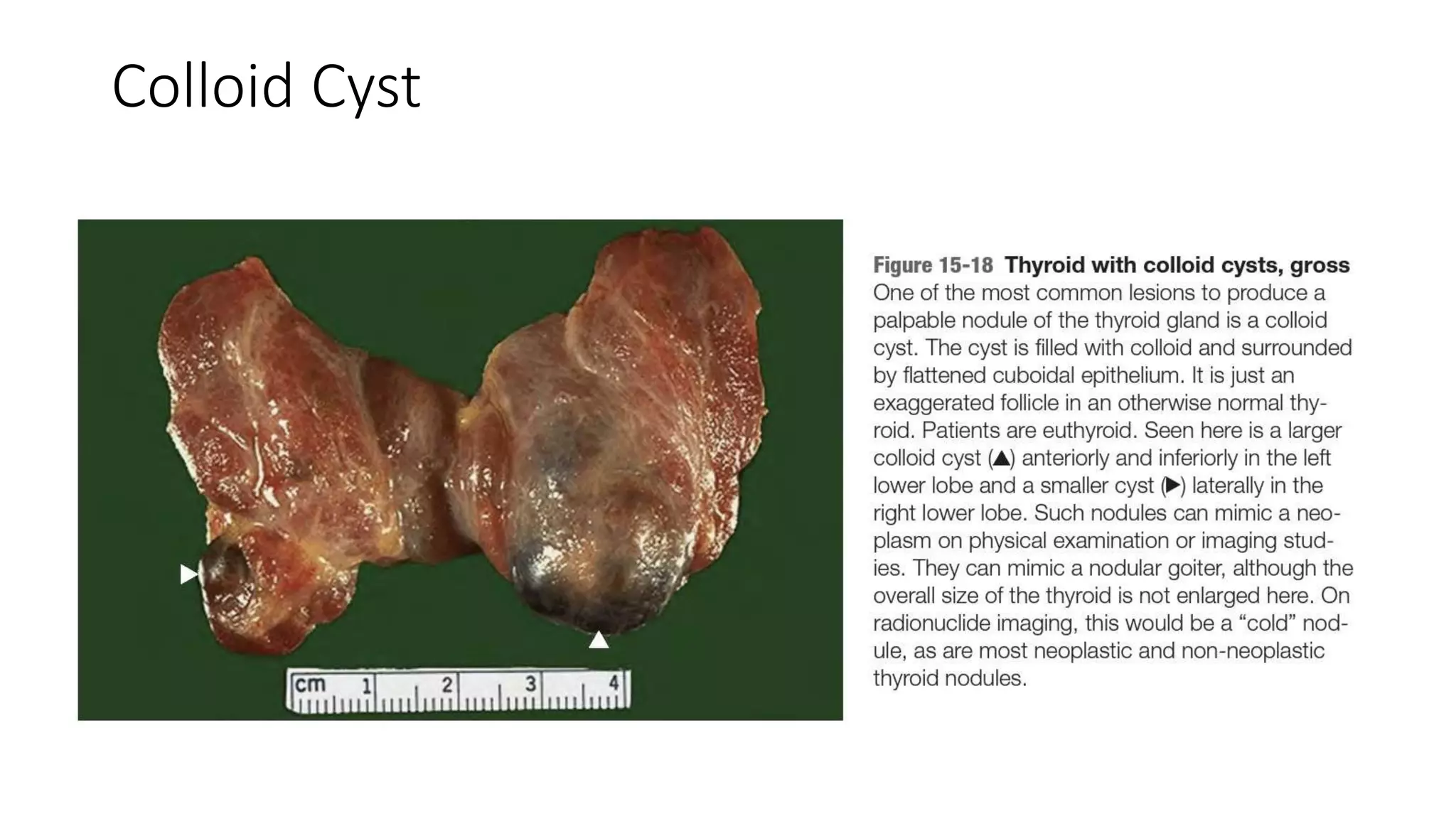 Grossing thyroid gland | PPTX