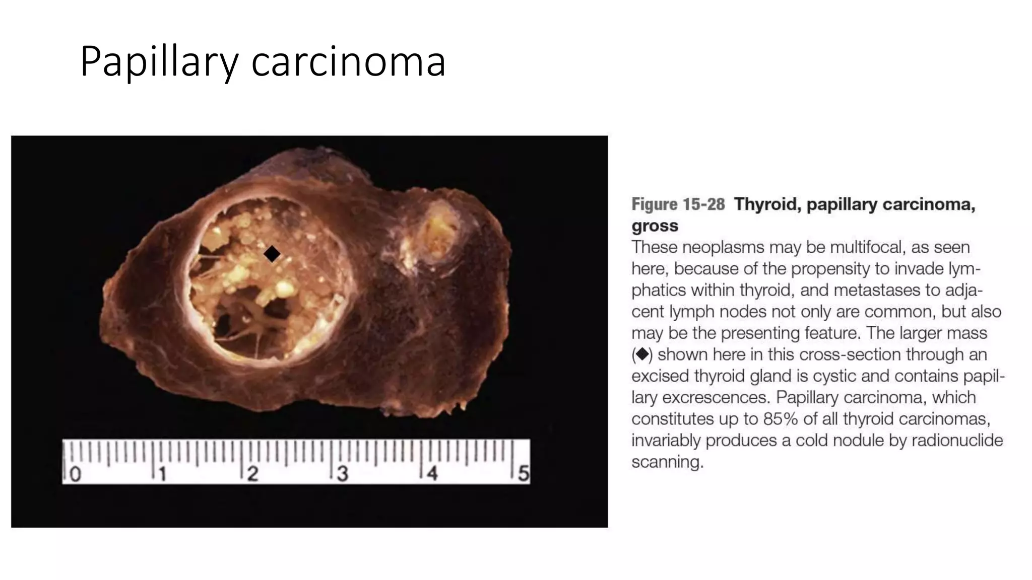 Grossing thyroid gland | PPTX