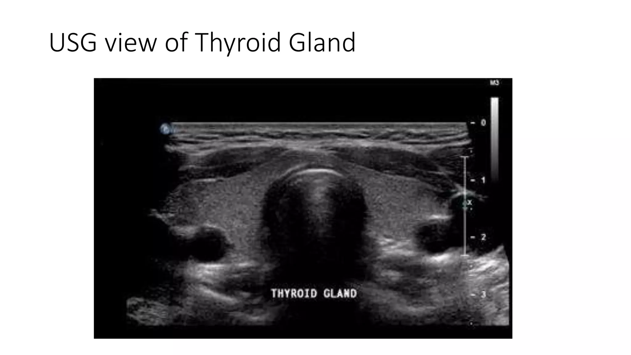 Grossing thyroid gland | PPTX