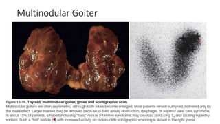 Grossing thyroid gland | PPTX