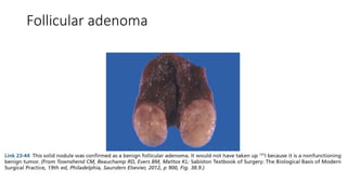 Grossing thyroid gland | PPTX