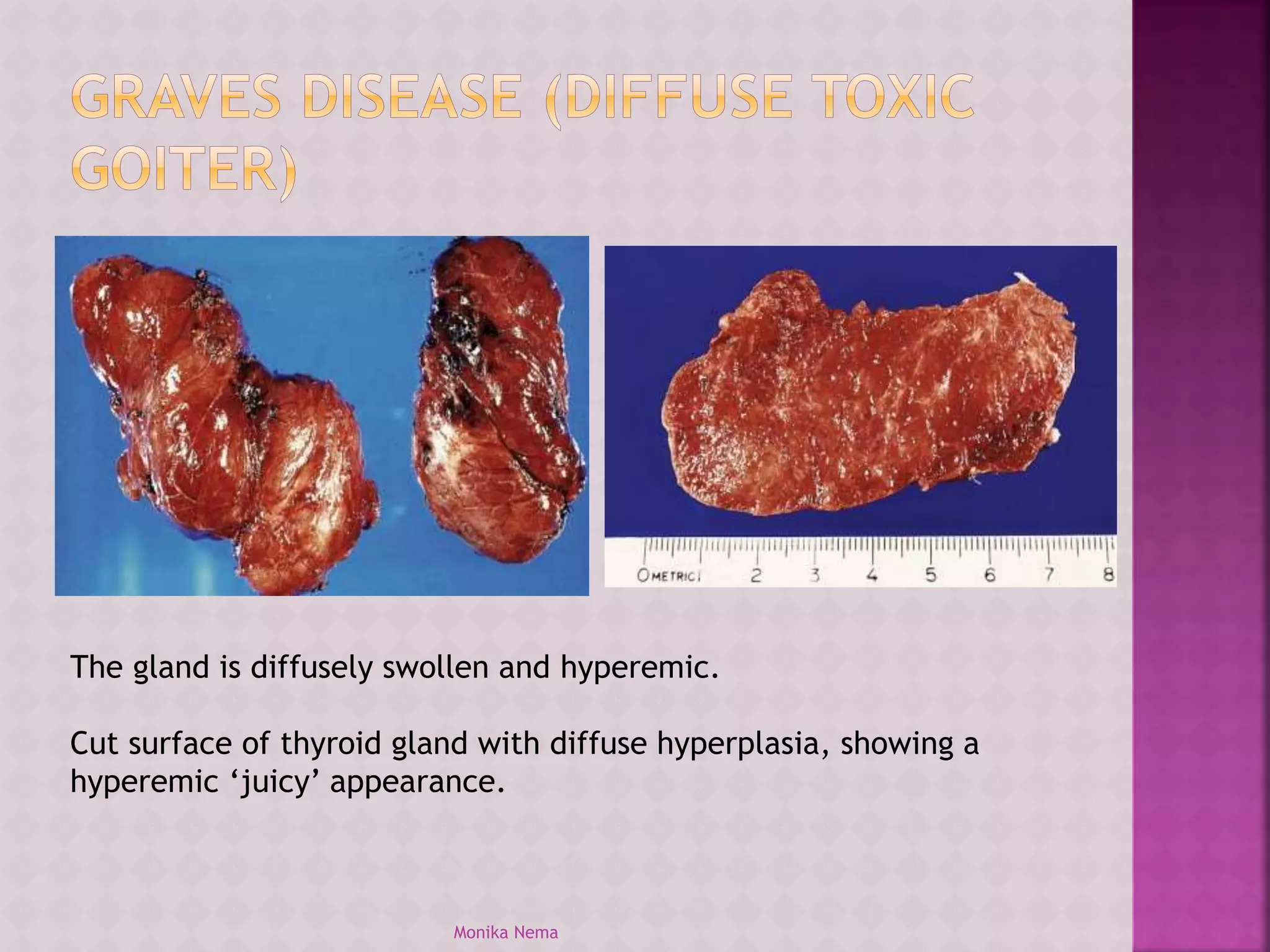 Gross of thyroid gland | PPTX