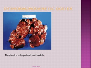 Multinodular Goiter Gross