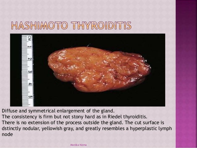 Gross of thyroid gland