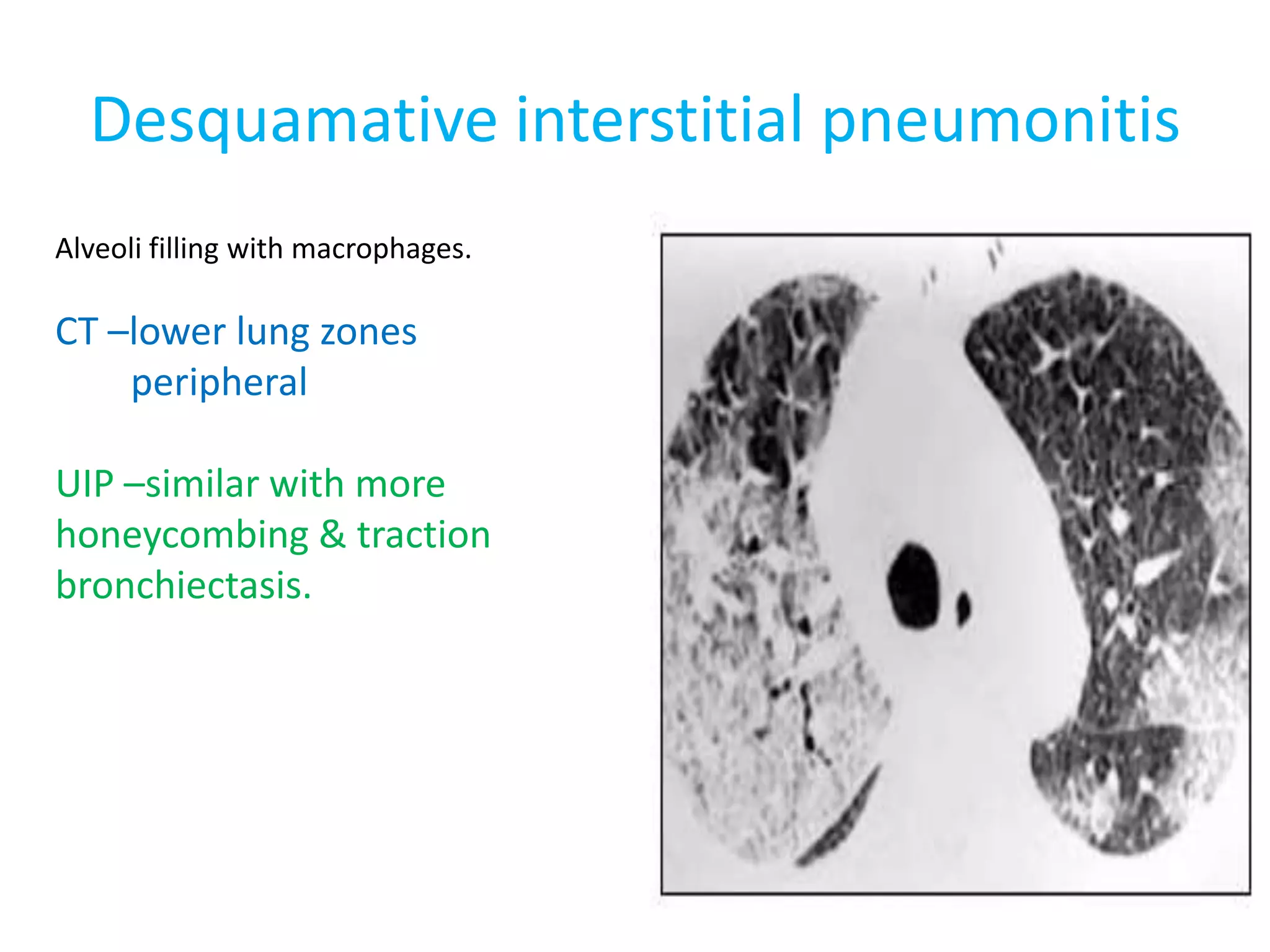 HRCT chest Ground glass opacities | PPTX