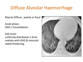 HRCT chest Ground glass opacities | PPTX