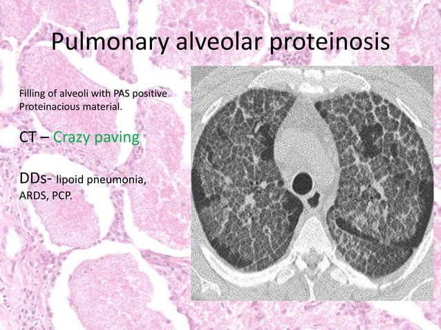 HRCT chest Ground glass opacities | PPTX