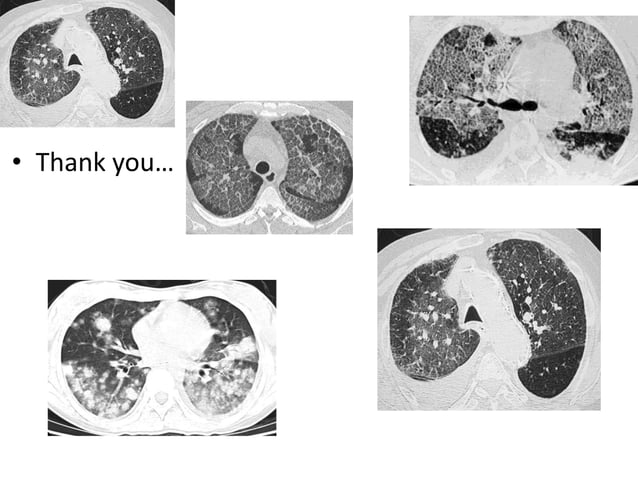 HRCT chest Ground glass opacities | PPTX