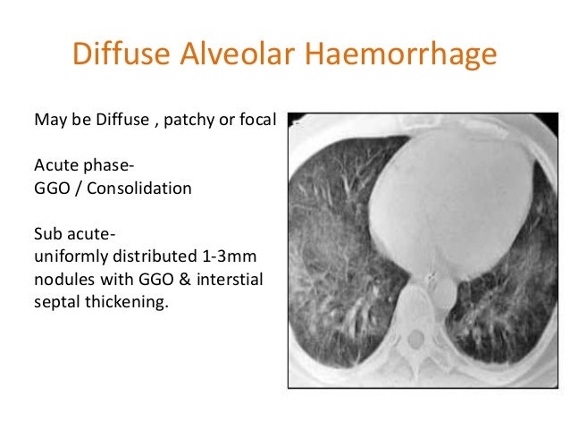 Hrct Chest Ground Glass Opacities