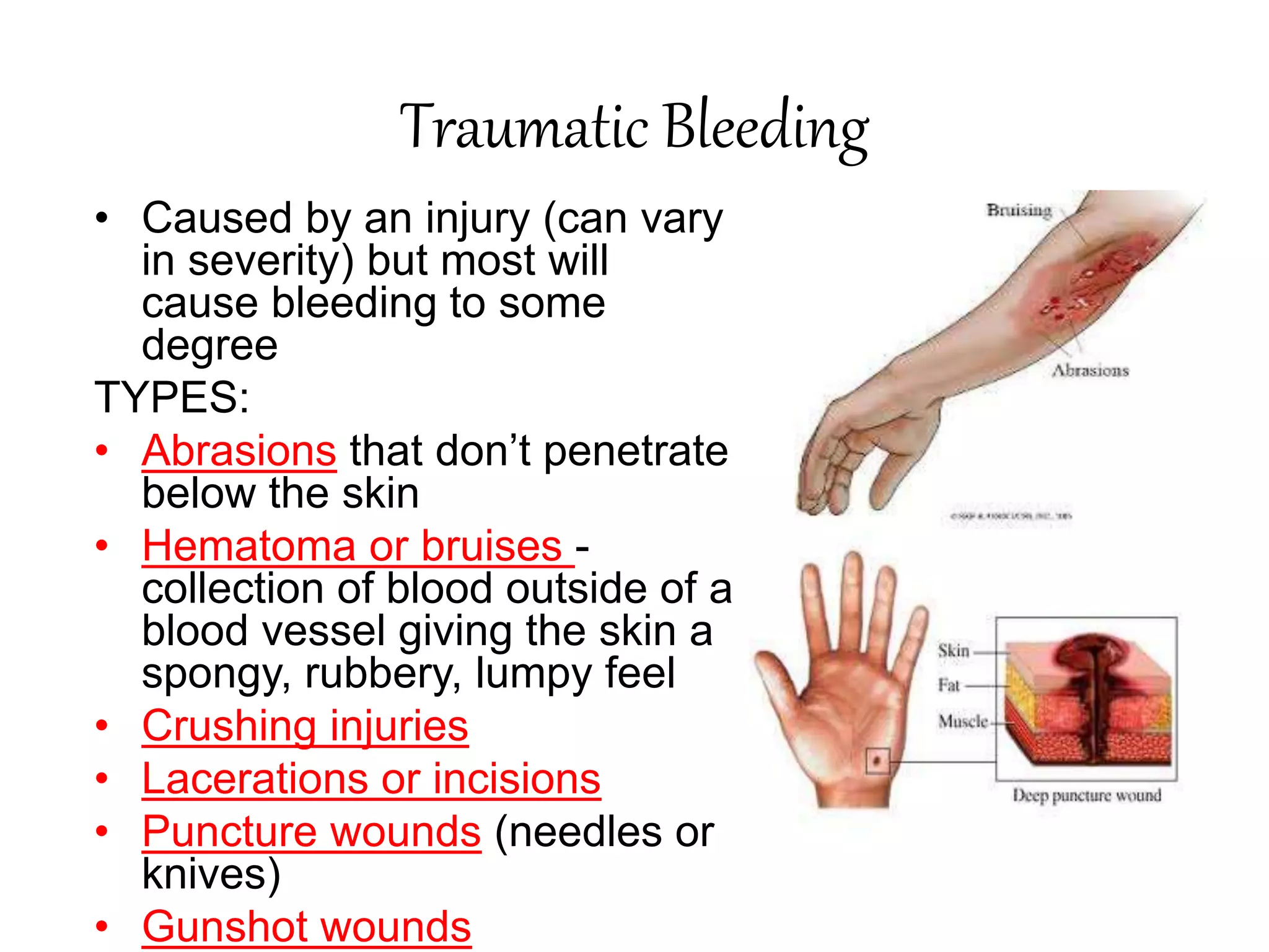 Basic First Aid (Bleeding) | PPTX