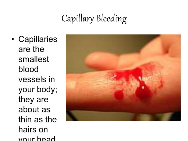 Basic First Aid (Bleeding) | PPTX