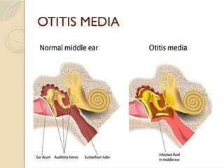 Disorder of the external and middle ear, otitis media and otosclerosis ...