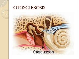 Disorder of the external and middle ear, otitis media and otosclerosis ...
