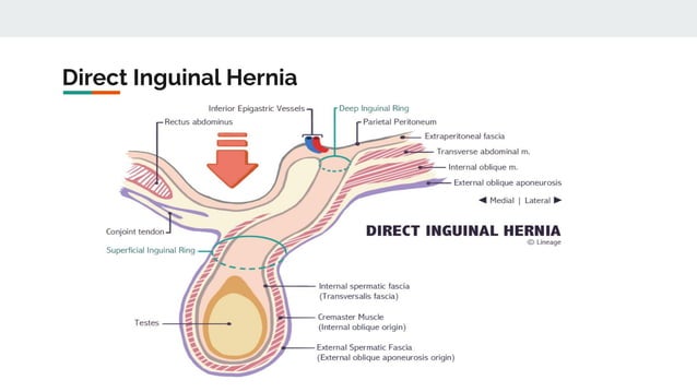 group 2 the best.pdf hernia and inguinal hernia | PDF