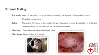 Hanging legal medicine | PPTX