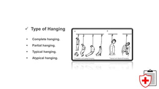 Hanging legal medicine | PPT