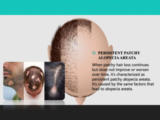 alopecia | PPTX