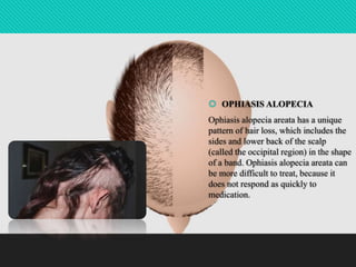 alopecia | PPT