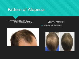 alopecia | PPT