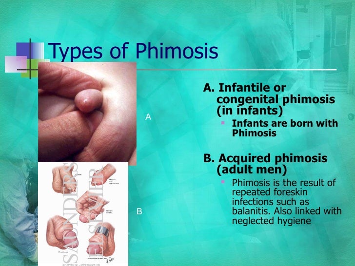 Phimosis And Paraphimosis In Children HWIX Phimosis And Paraphimosis In Children HWIX
