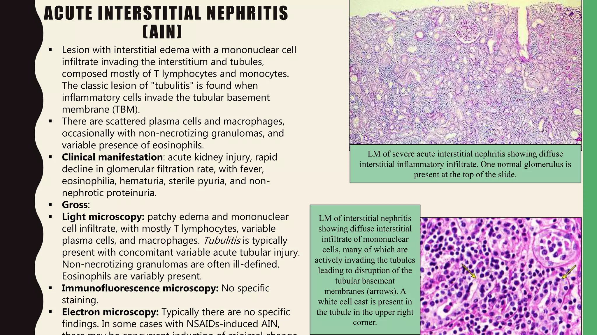 inflammatory diseases of the kidney& urinary bladder | PPTX