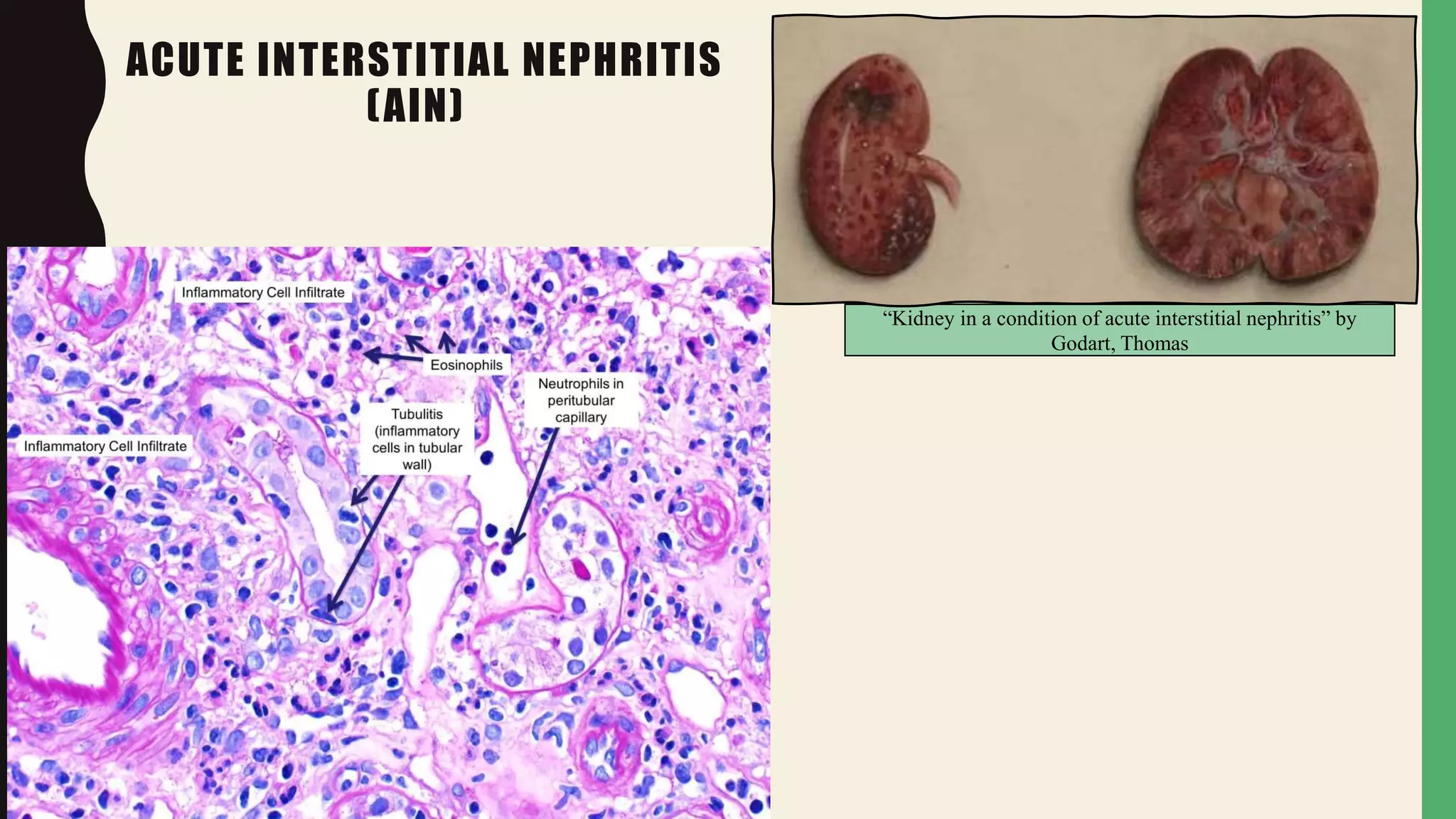 inflammatory diseases of the kidney& urinary bladder | PPTX