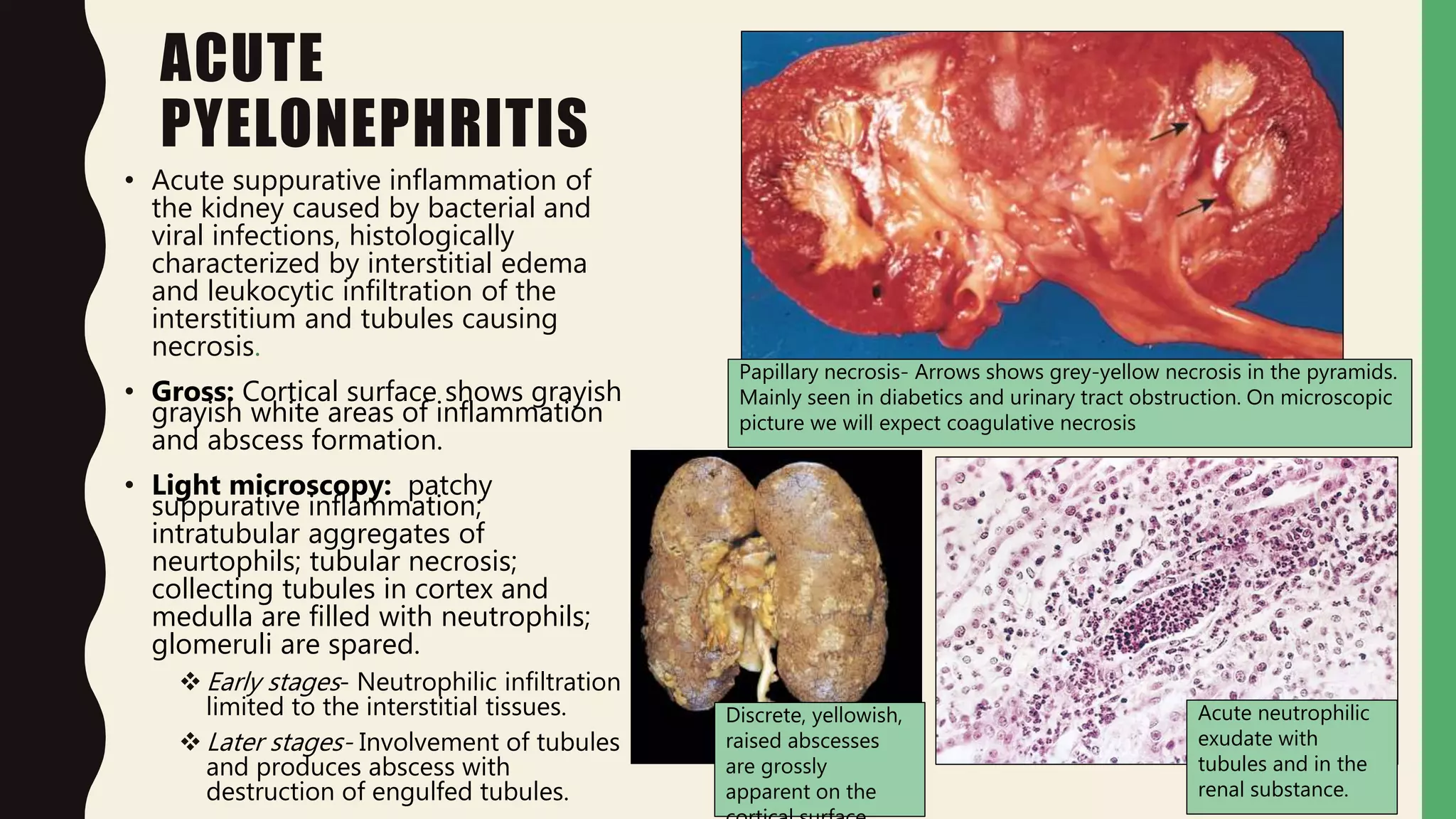 inflammatory diseases of the kidney& urinary bladder | PPTX