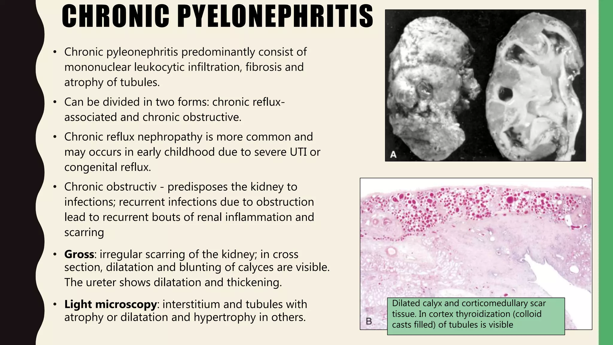 inflammatory diseases of the kidney& urinary bladder | PPTX