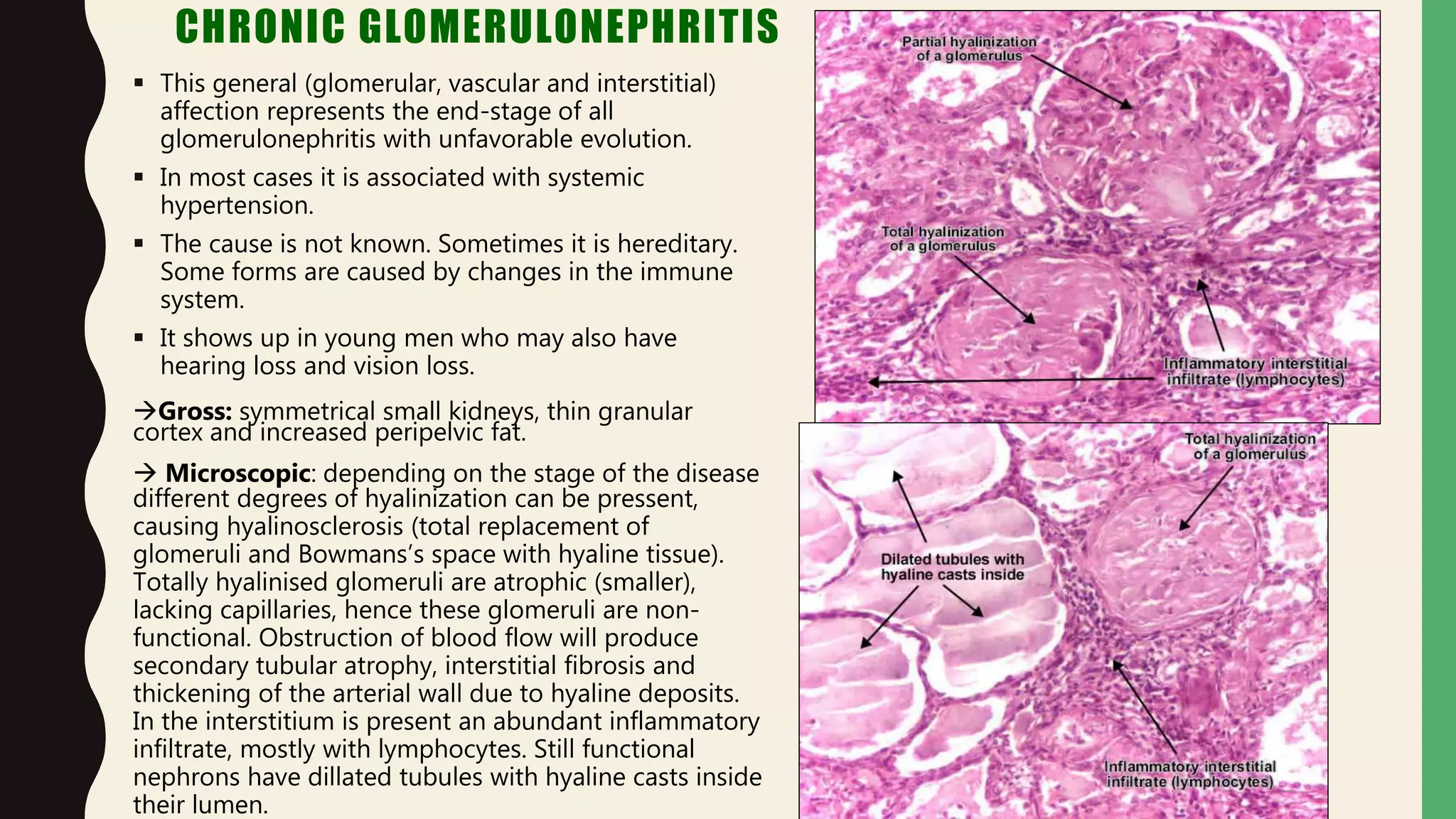 inflammatory diseases of the kidney& urinary bladder | PPTX