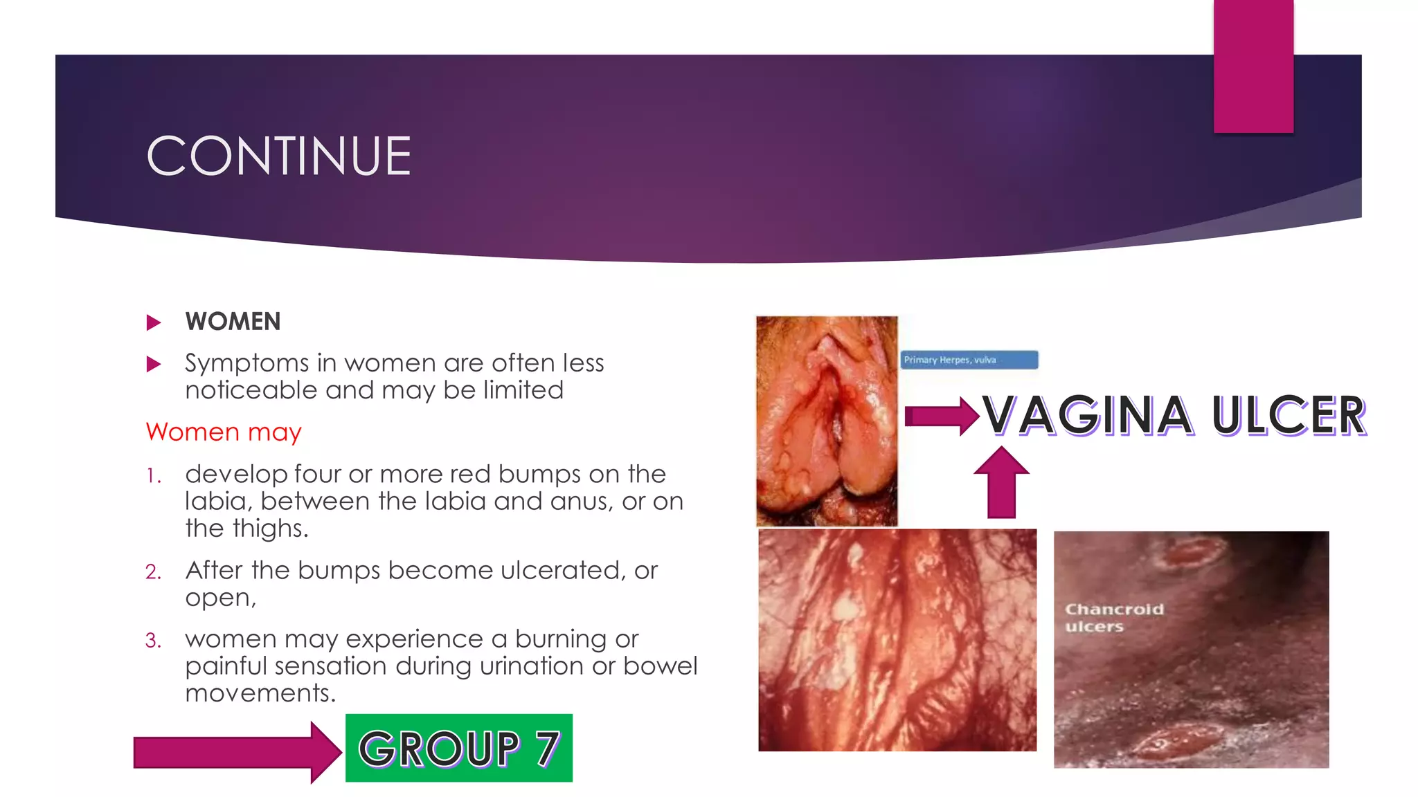 CHANCROID PRESENTATION FROM STUDENT @ CHNTS ESIAMA- C15B GROUP | PDF