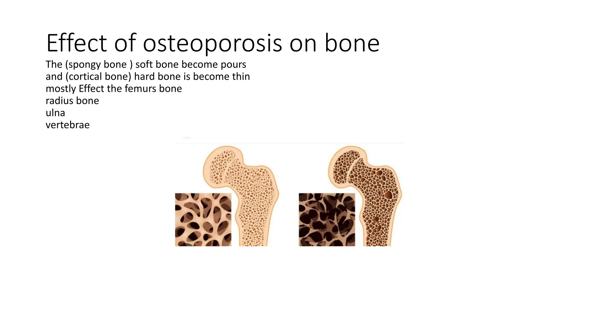 Breaking Down Osteoporosis Causes Symptoms Ppt