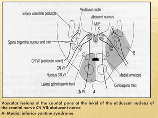 MEDIAL INFERIOR PONTINE SYNDROME | PPTX