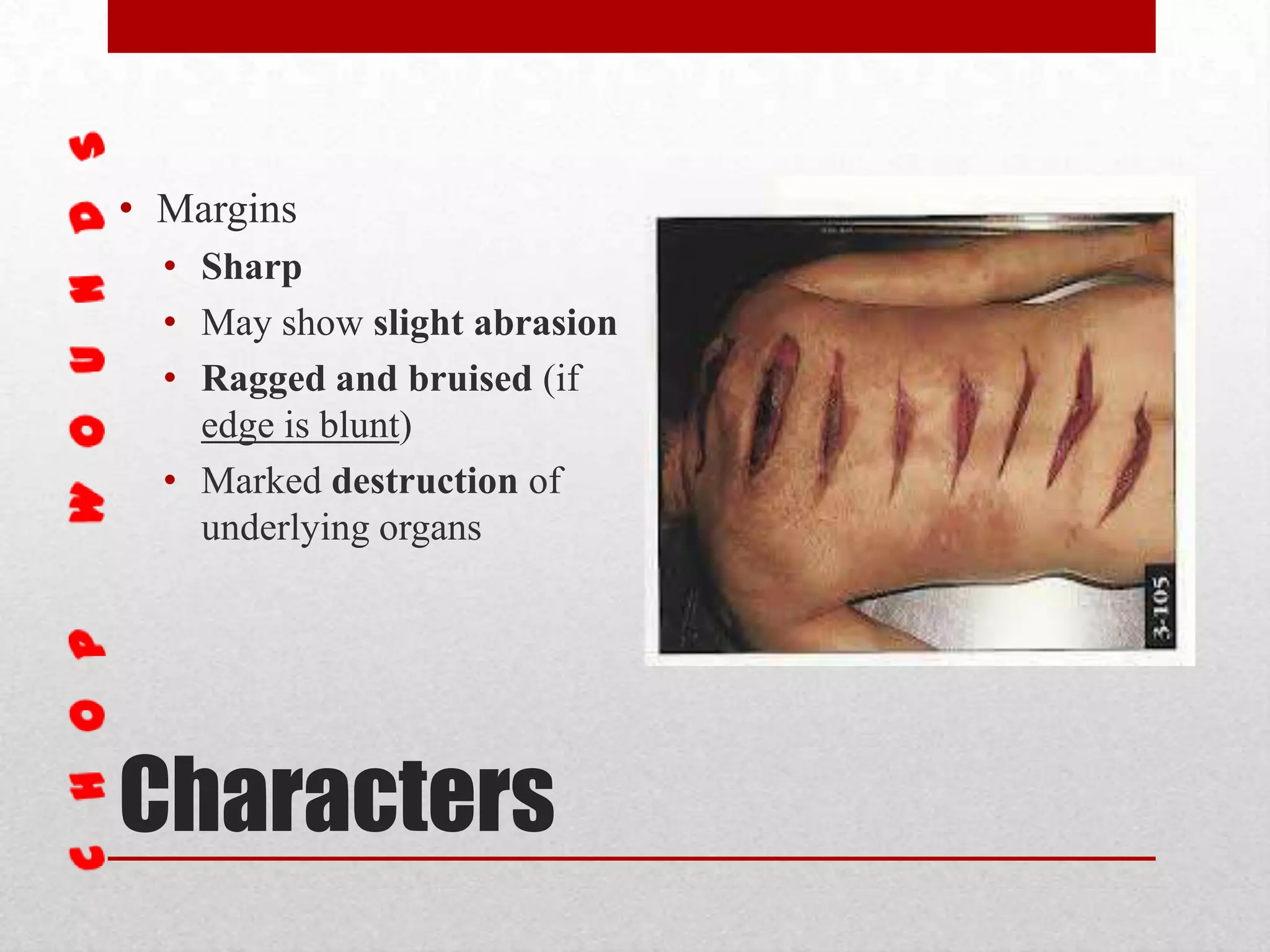 Mechanical injuries_Forensics | PPTX