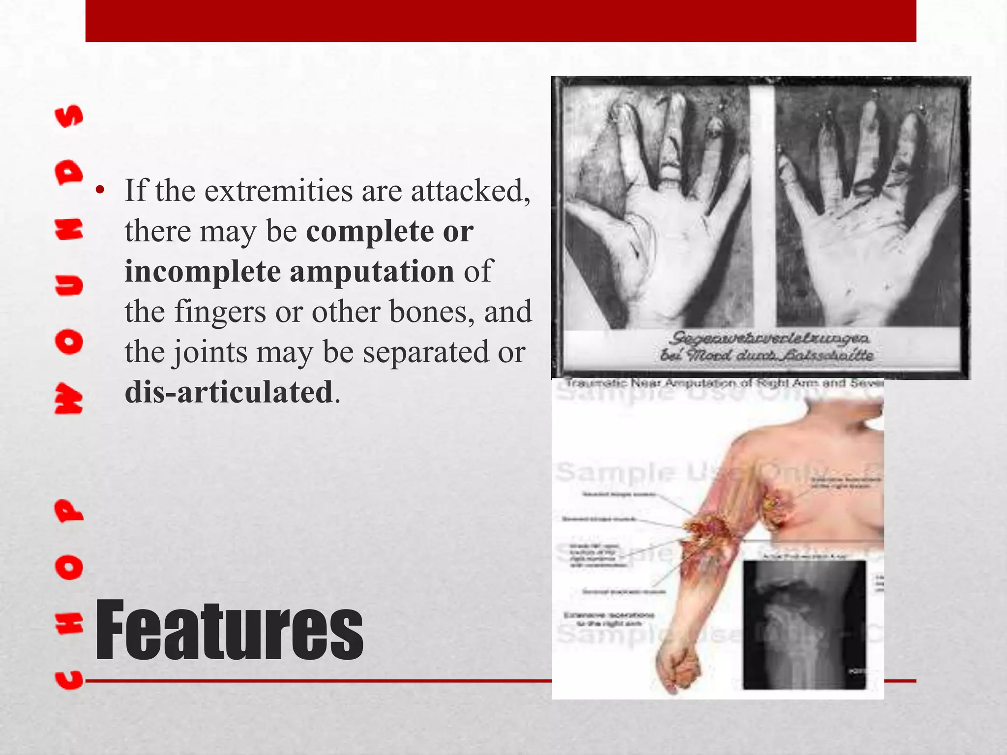 Mechanical injuries_Forensics | PPTX